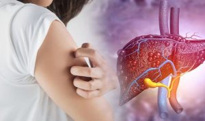 Fatty liver disease: Itching, bruising and yellow tinged skin indicates ...